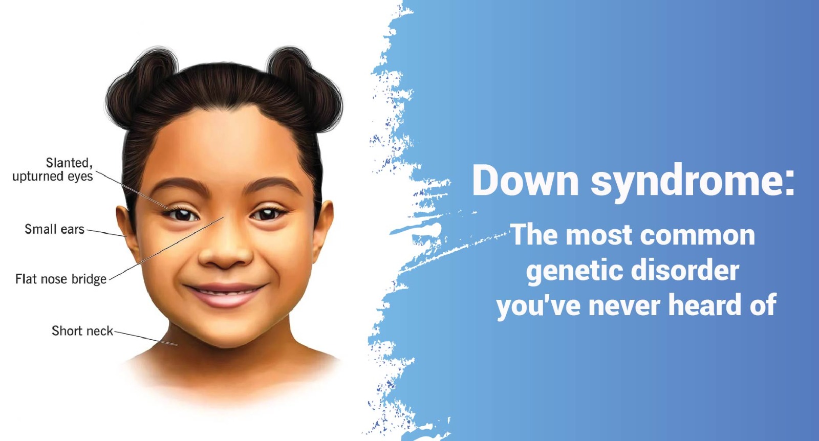 Down syndrome: The most common genetic disorder you've never heard of ...